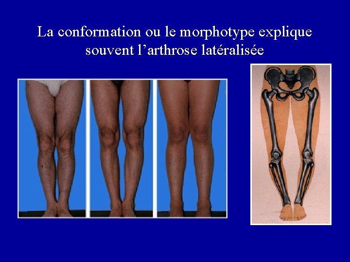 La gonarthrose LA GONARTHROSE Arthrose du genou Arthrose