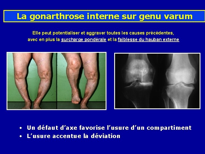 La gonarthrose LA GONARTHROSE Arthrose du genou Arthrose