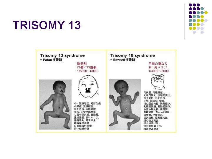 ULTRASOUND EVALUATION OF CHROMOSOMAL ABNORMALITIES HOLDORF DOWN SYNDROME