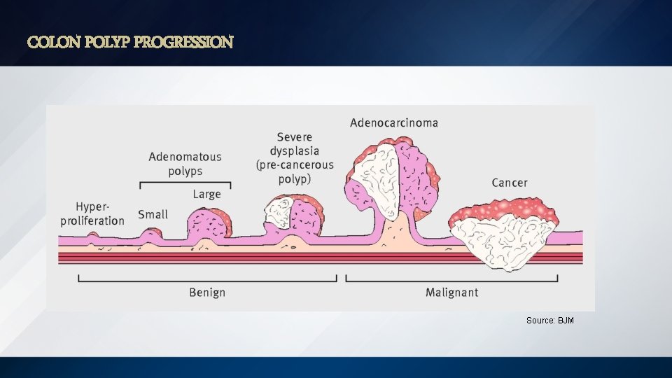 COLORECTAL CANCER SCREENING 2021 WEBINAR FEBRUARY 25 2021