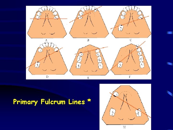Indirect Retainers Rola M Shadid BDS MSc Movement
