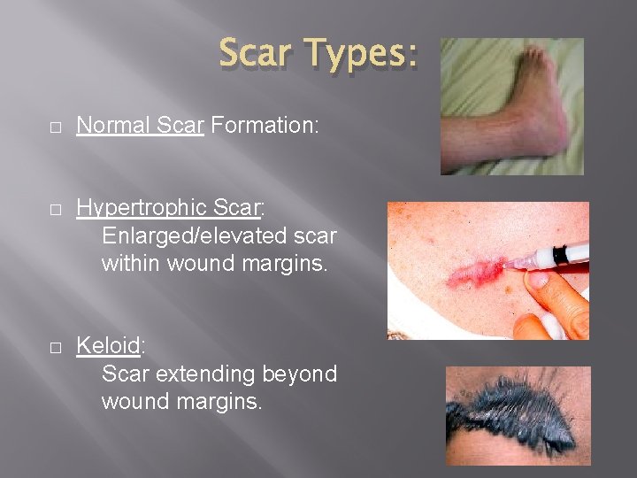 SCARS FORMATION TX AND PREVENTION Dan Preece CSPM