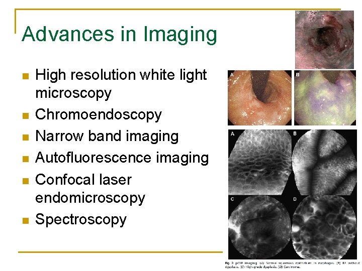 Management of Barretts Esophagus Joint Hospital Surgical Grand