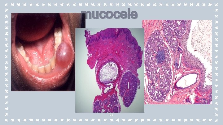 Pathology of The Gastrointestinal tract Ghadeer Hayel MD