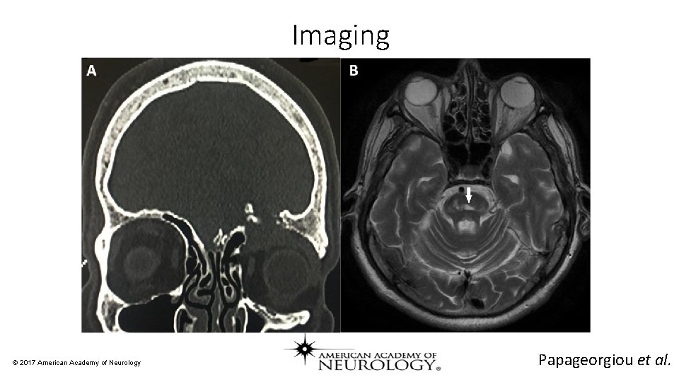 A 65 yearold man with double vision and