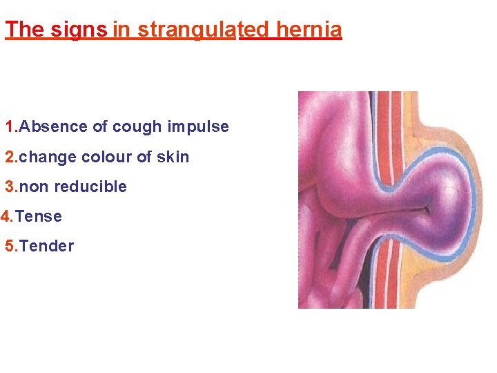 Abdominal wall hernia Hernia strap 1758 What is