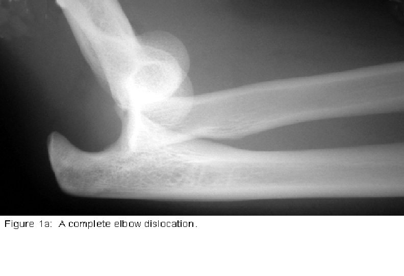 WARRAICH ROLL17 C Elbow Dislocation Basics History of
