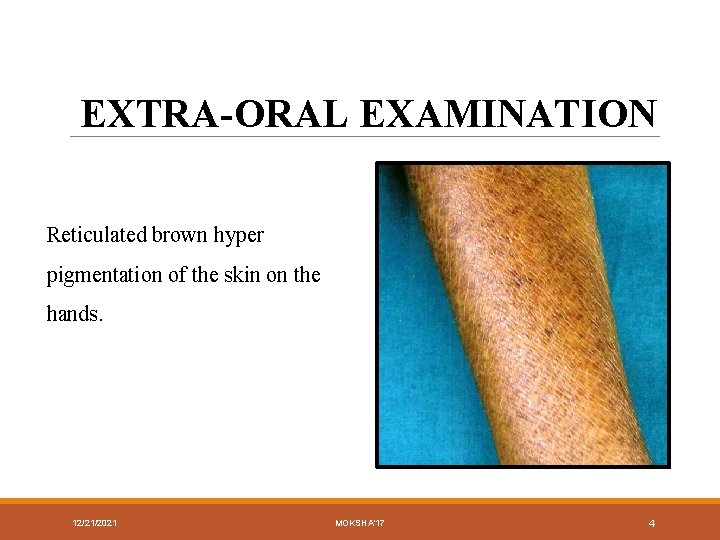 DESQUAMATIVE GINGIVITIS Does it always require a biopsy