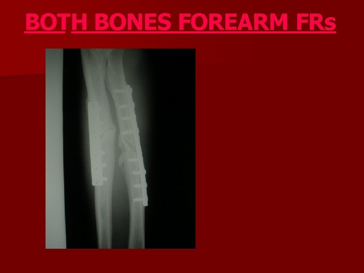LONG BONE INJURIES CLOSED FRACTURES OPEN FRACTURES PATHOLOGICAL