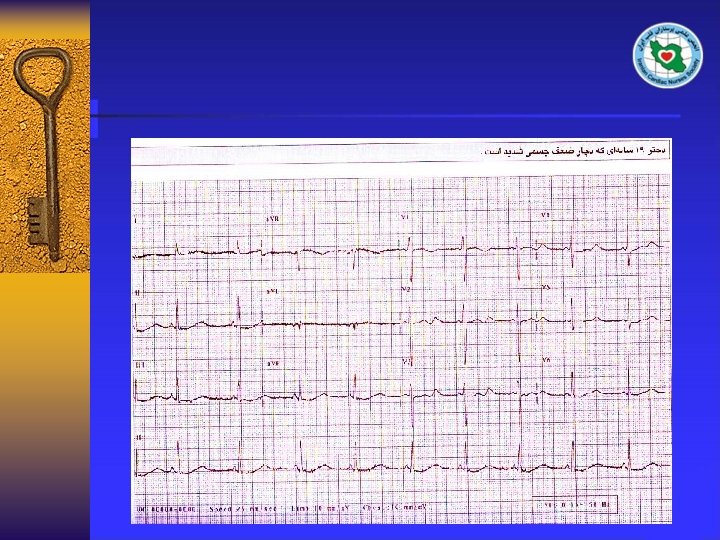 1 Electrolyte and ECG Changes Sodium Normal 135