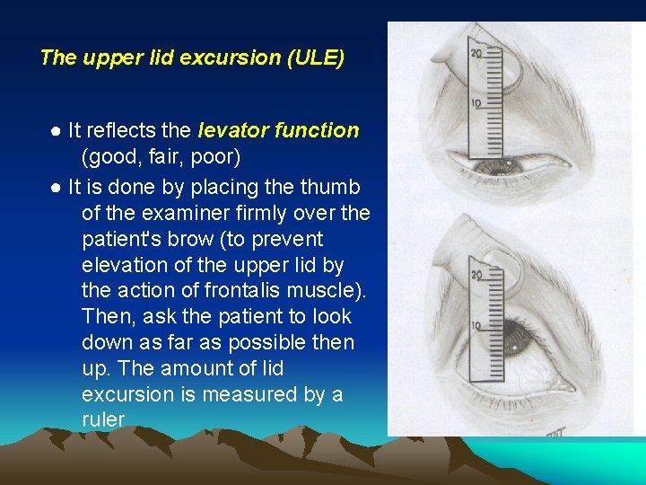 Clinical evaluation of ptosis 1 History 2 Exclusion