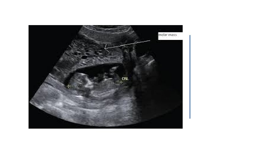 PARTIAL MOLAR PREGNANCY by Abeer Altamimi NORMAL FERTILIZATION