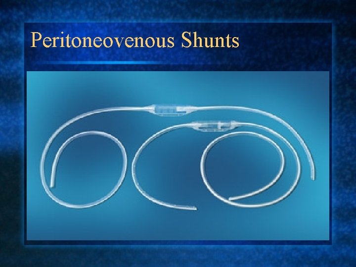 Ascites Management in Patients with Cirrhosis Roadmap l