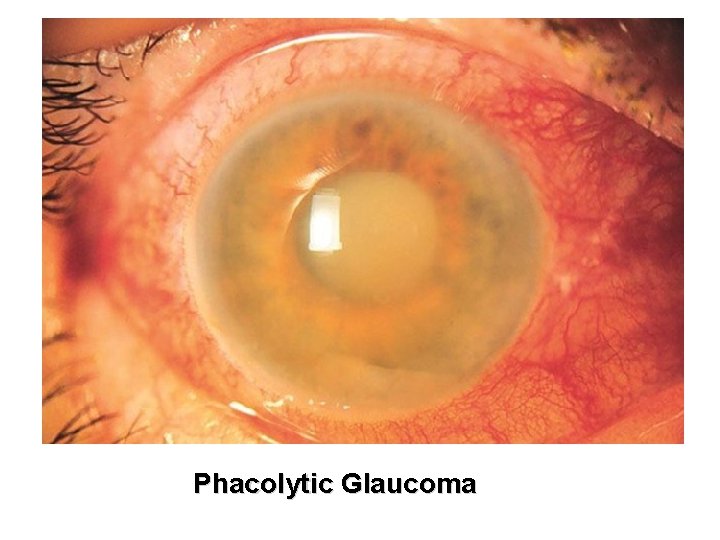 C Secondary Glaucomas Mechanism of aqueous outflow obstruction