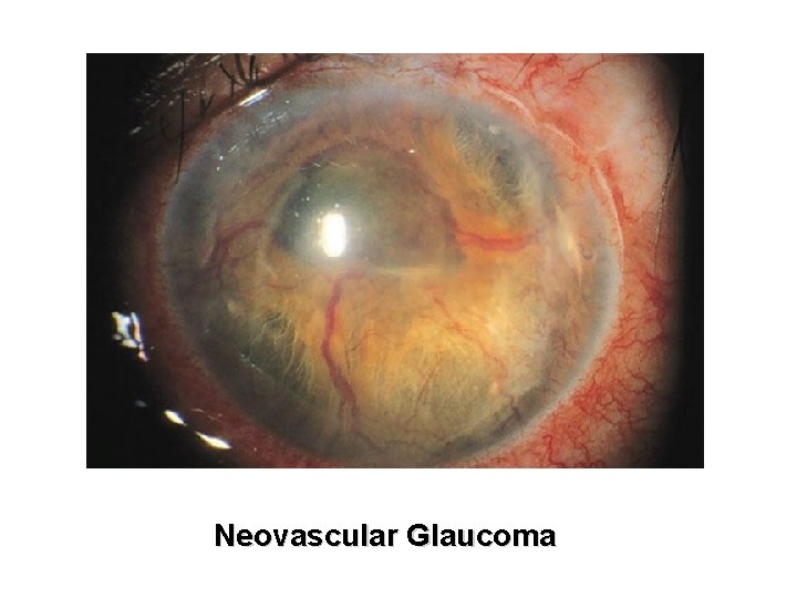C Secondary Glaucomas Mechanism of aqueous outflow obstruction