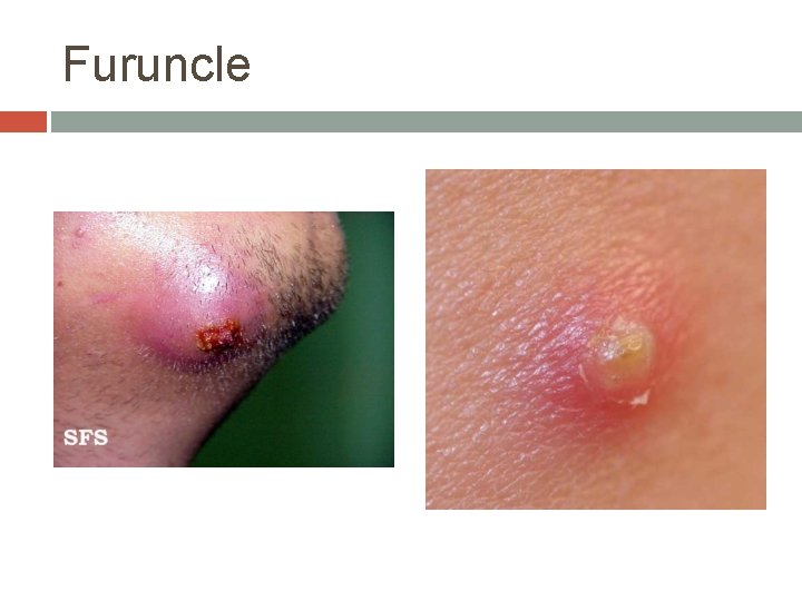 CHAPTER 4 MICROBIAL DISEASES OF THE SKIN Miss
