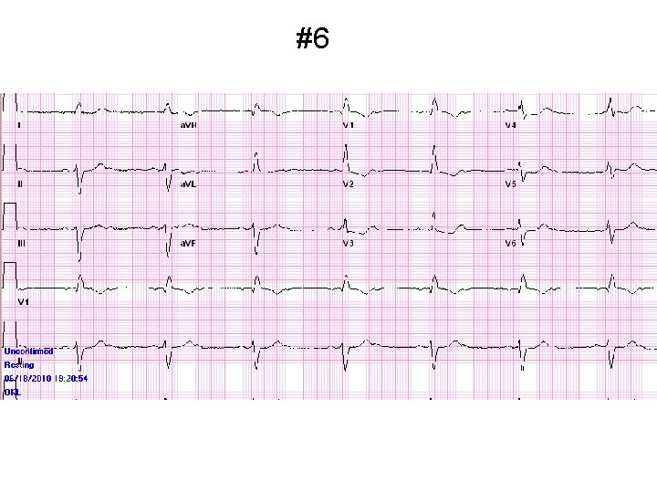 Dysrhythmia examples for residents Elias B Hanna LSU