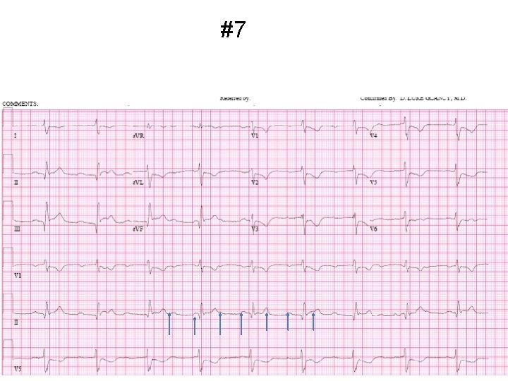 Dysrhythmia examples for residents Elias B Hanna LSU