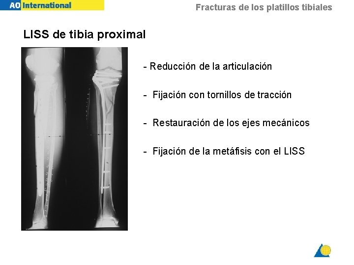 Fracturas de los platillos tibiales Fractura de los