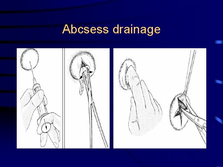 SURGICAL INFECTIONS Begashaw M MD Surgical infection Defined