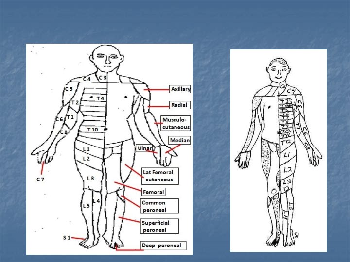 Somatosensory lesions for distribution decussation 3 neuron pathway