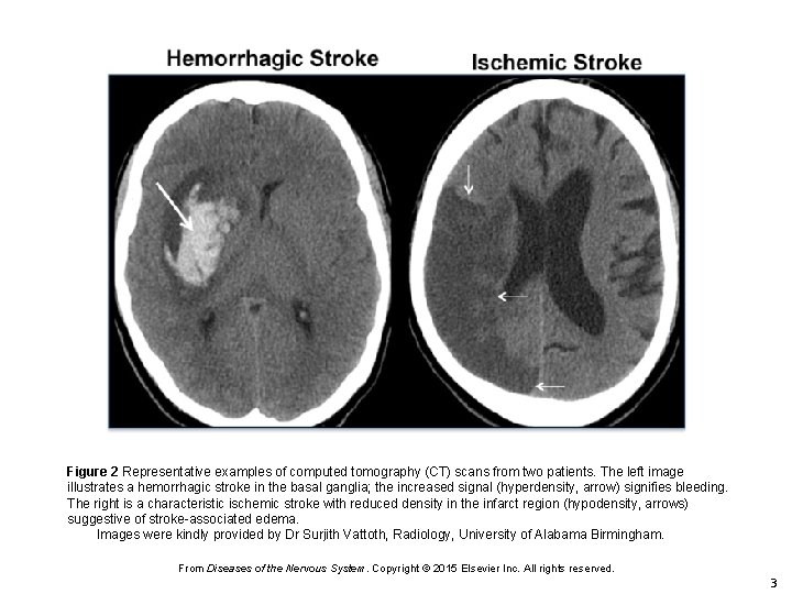 Chapter 1 Cerebrovascular Infarct From Diseases of the