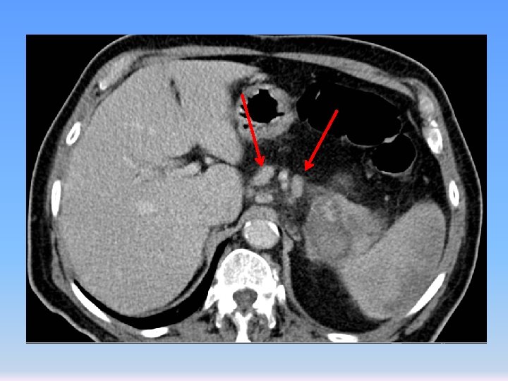 A bleeding hole Dr E Thomson Radiology Registrar