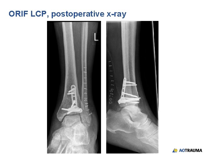 Articular fractures of the tibia moderated interactive session