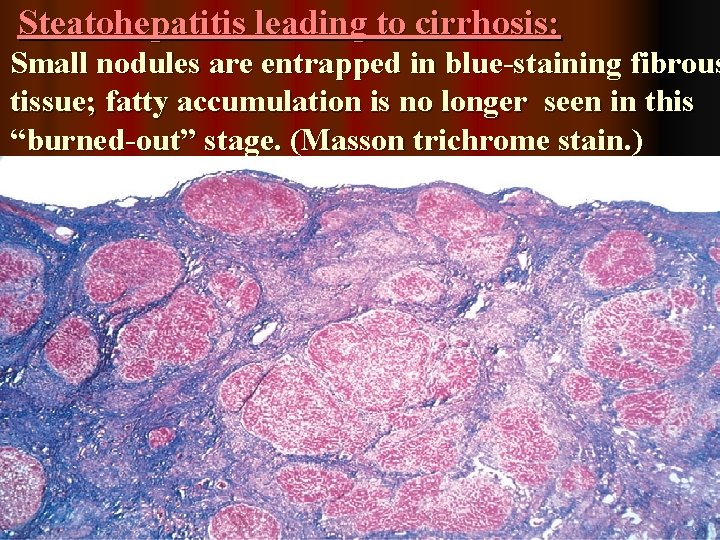 Lecture 8 Liver diseases Cholestasis Cirrhosis Liver Normal