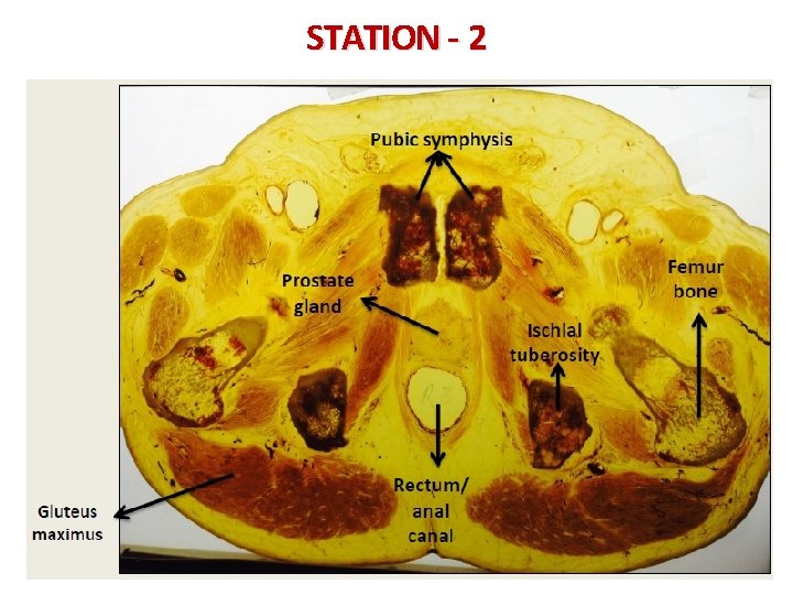 DEMO IV Embryology of Reproductive System Perineum and
