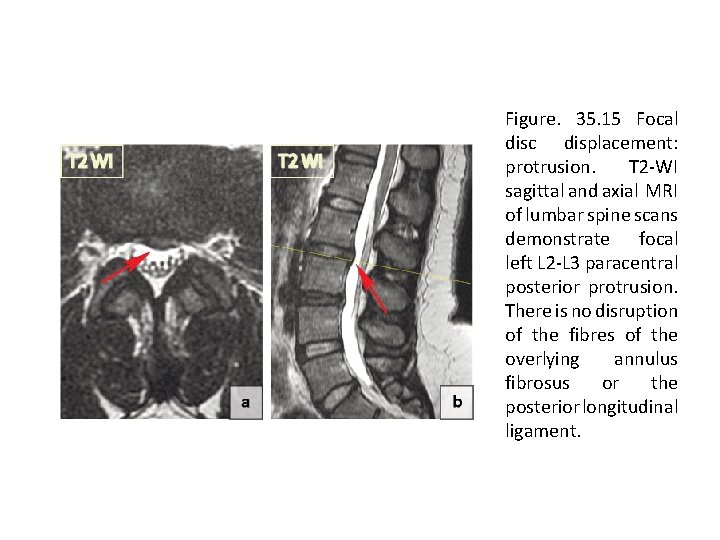 MRI of spinal cord Dr Aminur Rahman FCPS