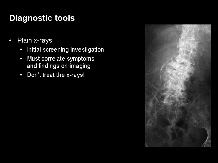 Clinical and xray assessment of degenerative back pain