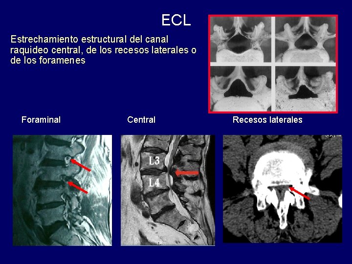 Tratamiento Quirrgico De La Estenosis De Canal Lumbar