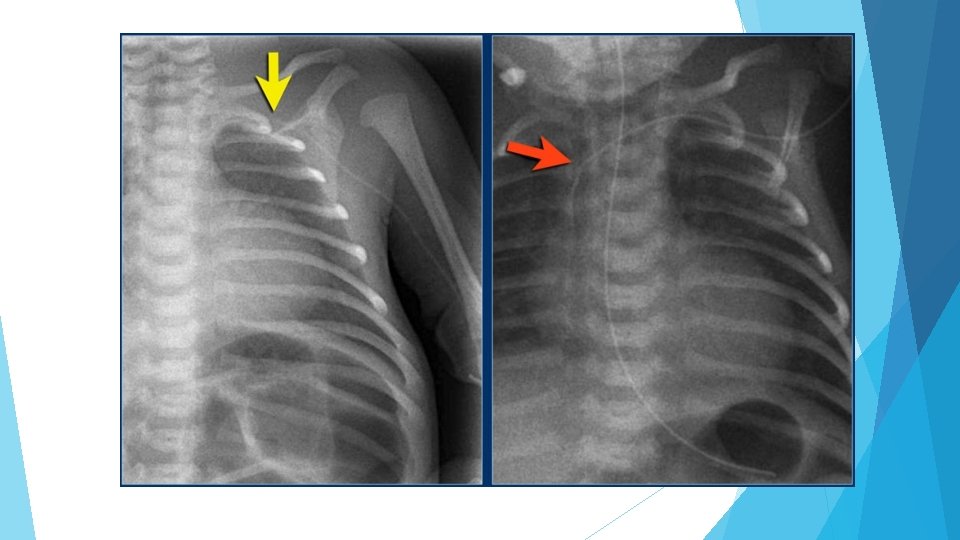 Central lines in pediatric patients Lauren Fortier NP