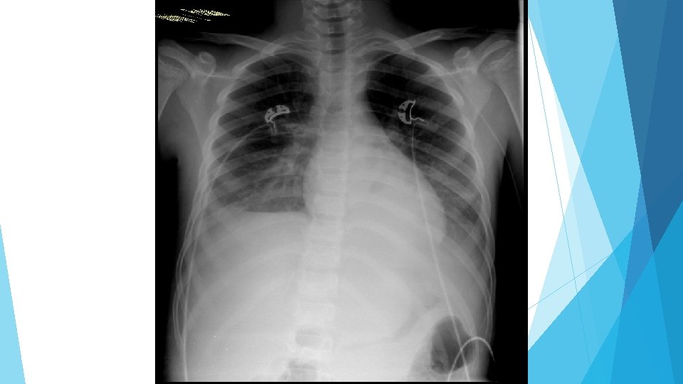 Central lines in pediatric patients Lauren Fortier NP