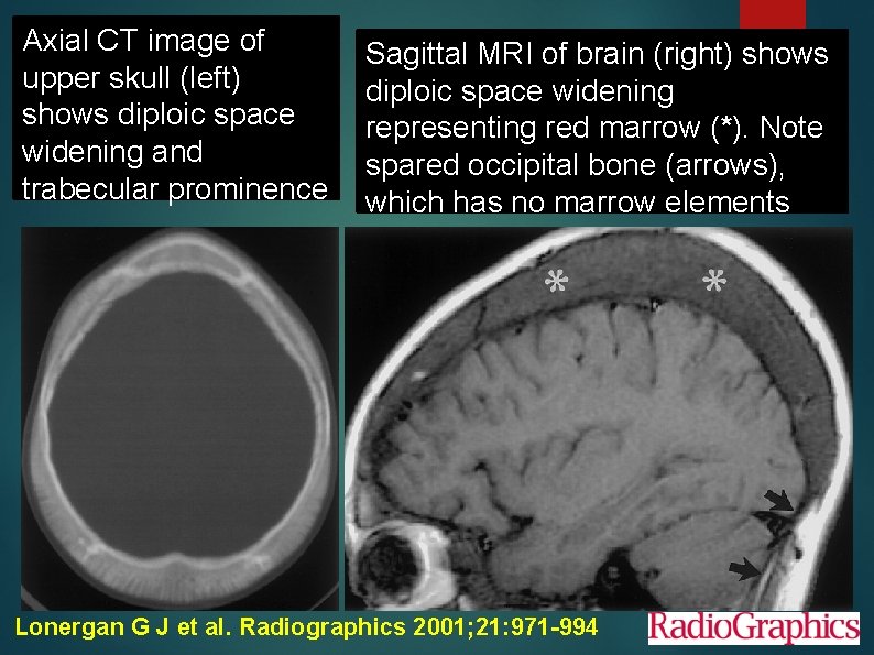 RADIOLOGY of HEMATOPOIETIC DISORDERS DR Abdulrahman Alhawas ASSISTANT