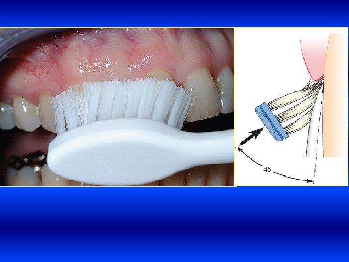PLAQUE CONTROL FOR THE PERIODONTAL PATIENT Plaque control
