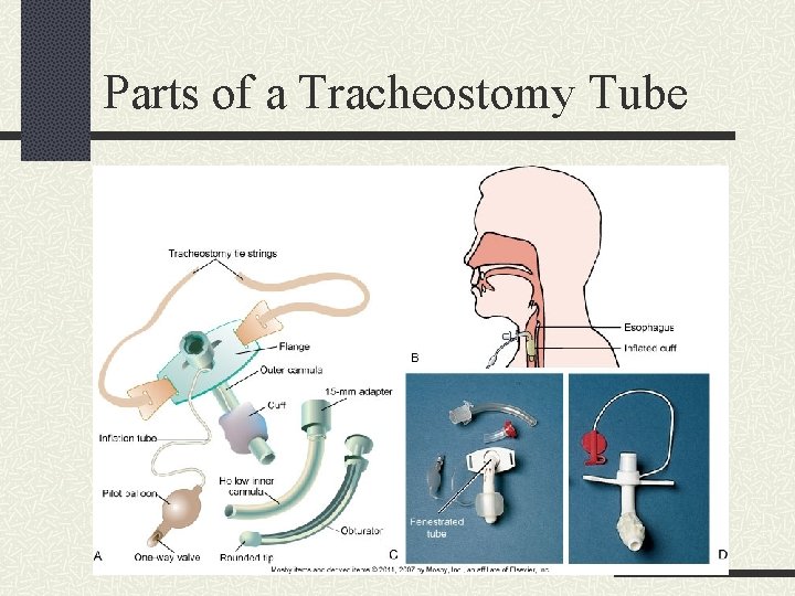 Tracheostomy Care Definition Tracheotomy n Surgical incision into