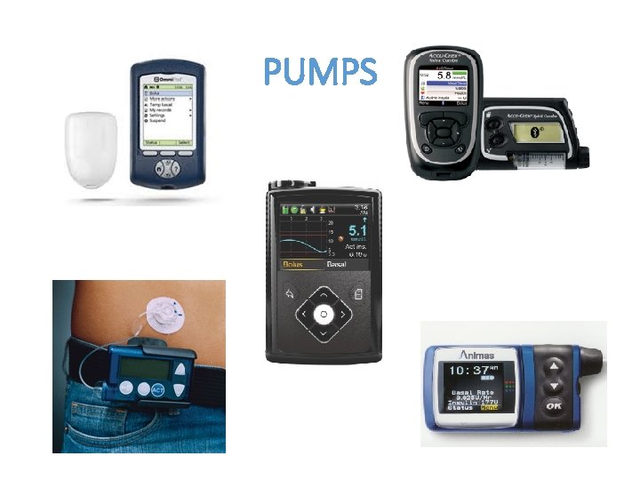 Diabetes and Insulin Pumps PUMPS Cannulas The insulin