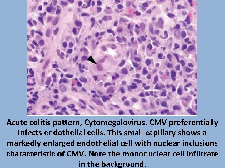 ACUTE COLITIS PATTERN Acute colitis An injury pattern