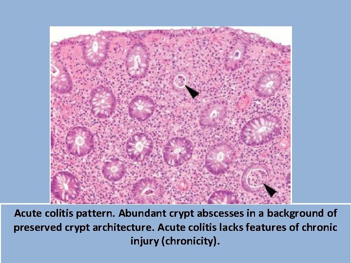 ACUTE COLITIS PATTERN Acute colitis An injury pattern