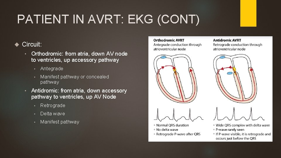 AVRT ATRIAL VENTRICULAR REENTRANT TACHYCARDIA JAZMINE BOLOOR PATIENT
