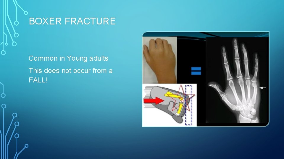 ORHTO PEDS BOXER FRACTURE Common in Young adults