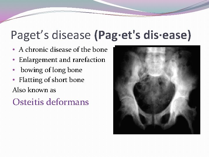 Pagets Disease By Cheyenne Holbrook Pagets disease Pagets