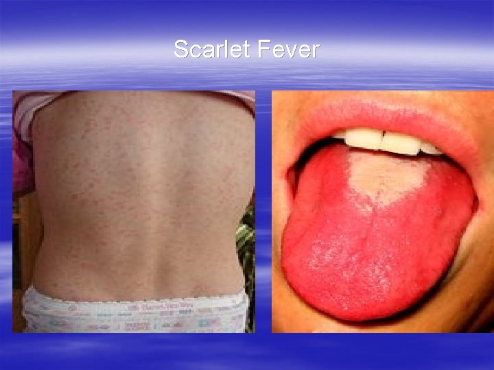 Bacterial Respiratory Infection 3 rd Year Medicine Prof