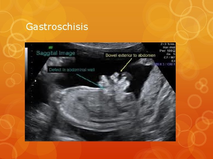 Obstetrical Sonography II Lecture 15 The Fetal Abdominal