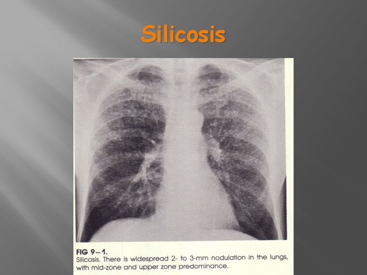 OCCUPATIONAL LUNG DISEASES Ali naserbakht MD www payeshteb