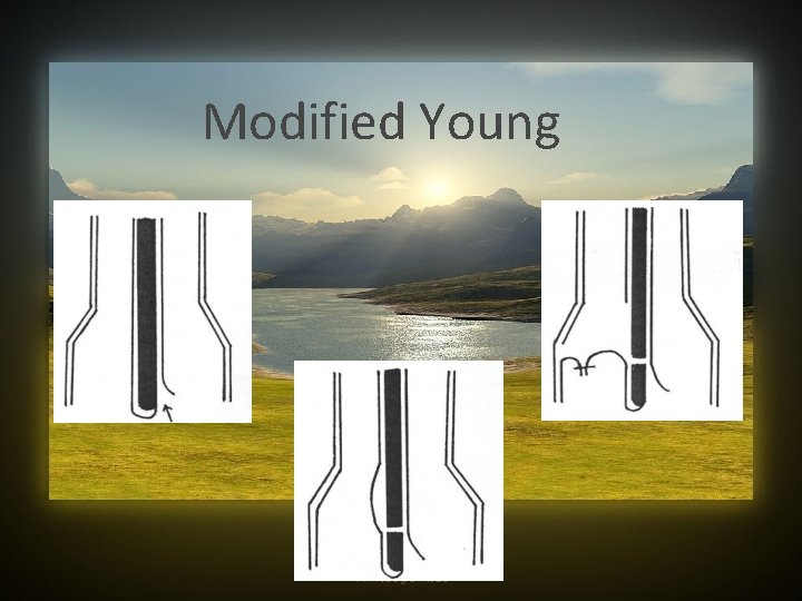 ACUTE AND CHRONIC RHINITIS ByDr Sudeep K C