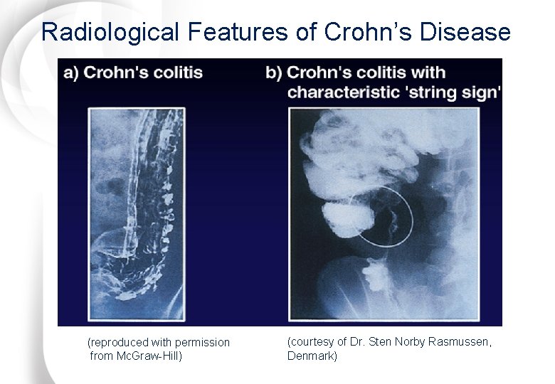 Inflammatory Bowel Diseases Crohns Disease and Ulcerative Colitis