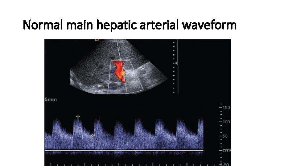 Postoperative doppler evaluation of liver transplants By Dr